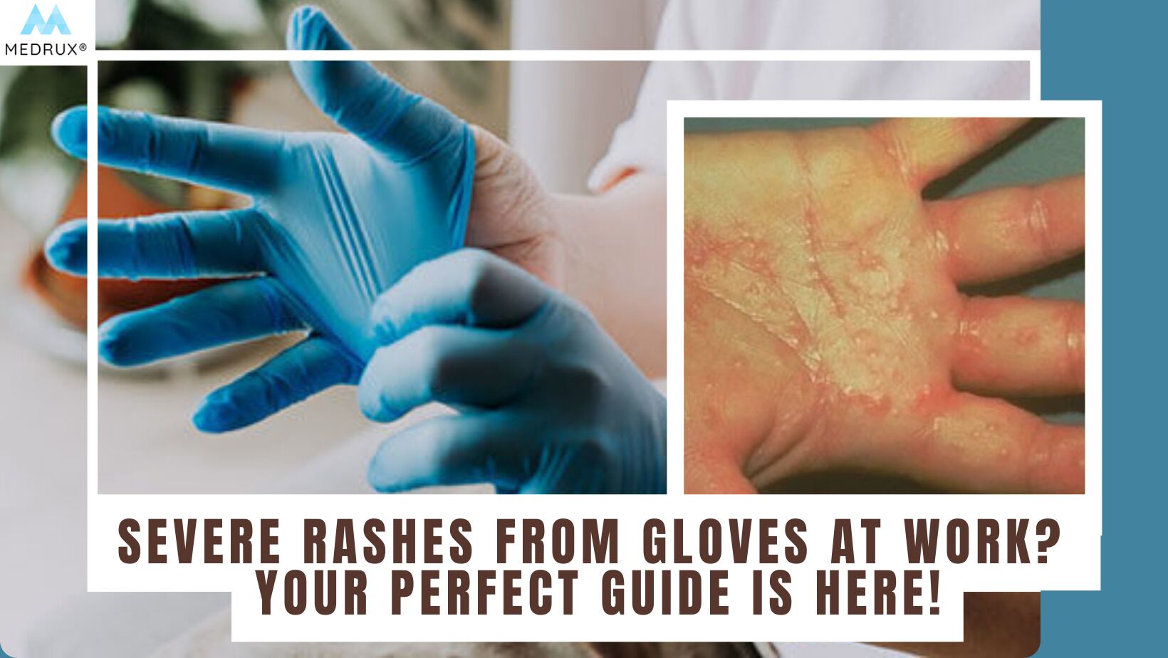 Severe Rashes From Gloves At Work? Your Perfect Guide Is Here! - Medrux